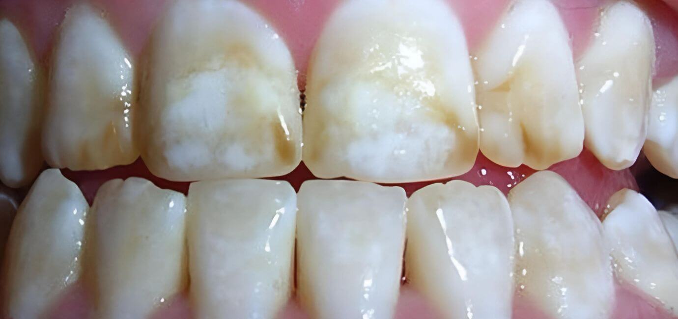 Discromie dentali: cosa sono?